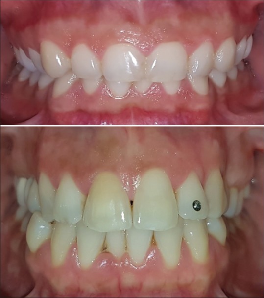 Depigmentation - ARISE DENTAL CARE